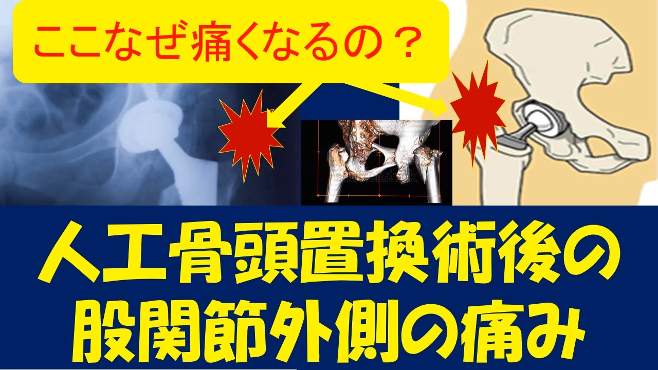 大腿骨頸部骨折術後の股関節外側部の痛みの原因は〇〇！最小侵襲進行関節手術の術後の皮膚、筋、神経の影響について解説 ニコニコ動画